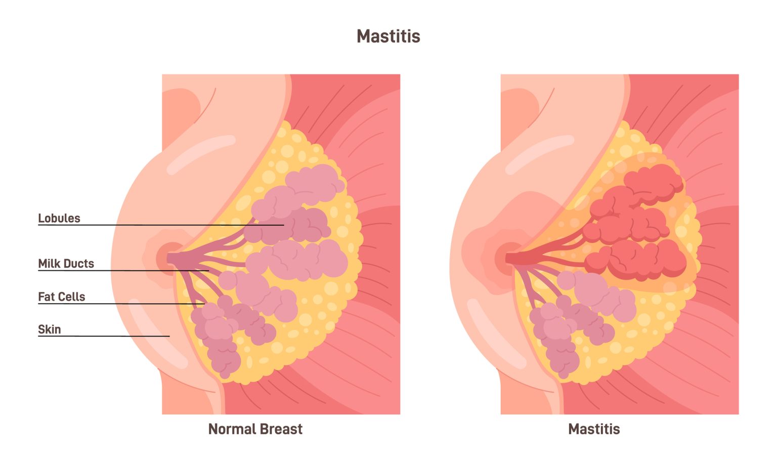 Signs of mastitis: causes, prevention and care - The Mother Baby Center
