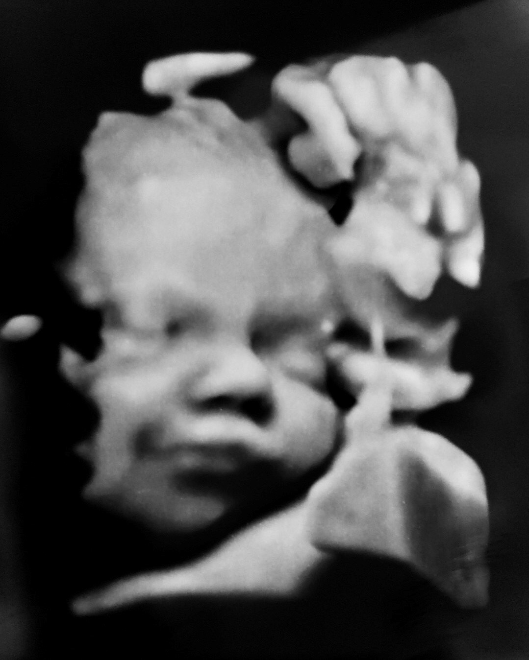 Treatment before birth: baby Xander’s successful journey from SVT and ...